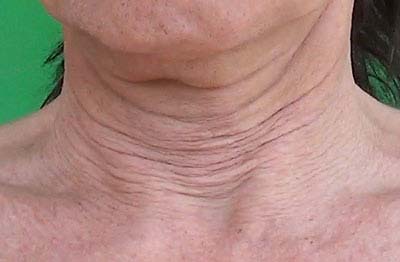 The main cutaneous folds on the human body